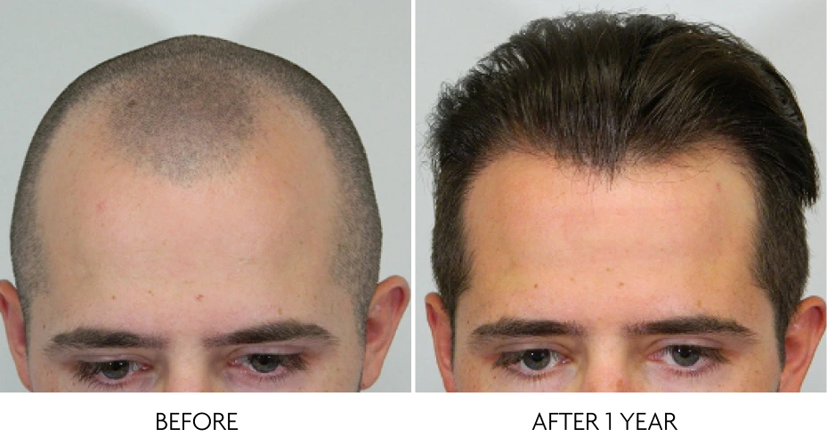 Hair Transplant Surgery in Boston, MA | NE Hair